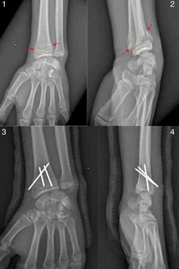 Fracture de Pouteau-Colles (poignet) : Mes 5 Conseils Kiné