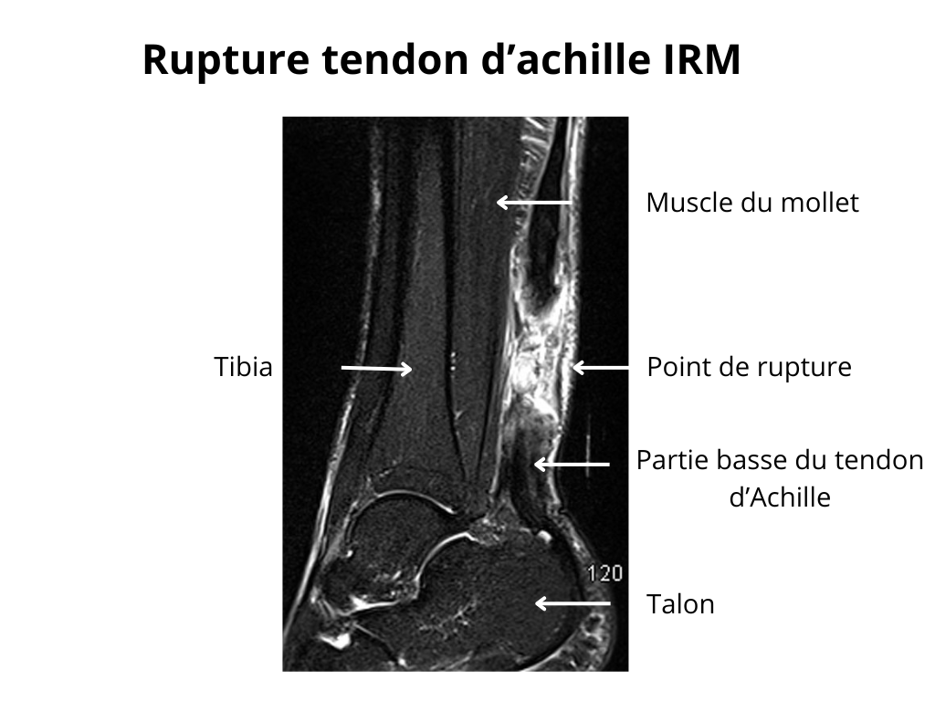 Rupture du Tendon d'Achille : Quelle rééducation faire ? Mes 3 Conseils
