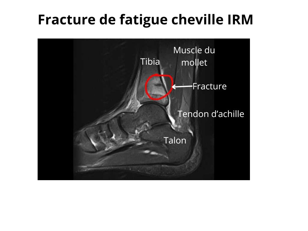 Fracture de fatigue : C'est quoi ? Que faire ? Quel temps de guérison